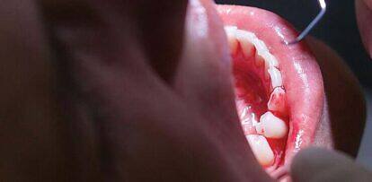 Khat Addiction: Effects, Risks, and Treatment Options